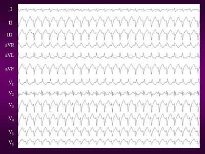 Normal Electrocardiogram (EKG)