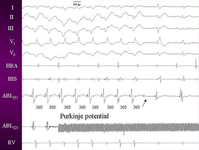 Clockwise Rotation Ecg